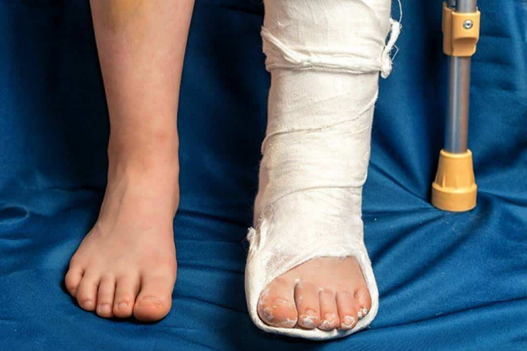 Como recuperar rápido de uma fratura? – Policonsultas